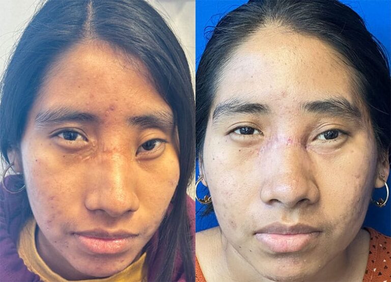 Reconstruction Before & Afters - MD Art Plastic Surgery