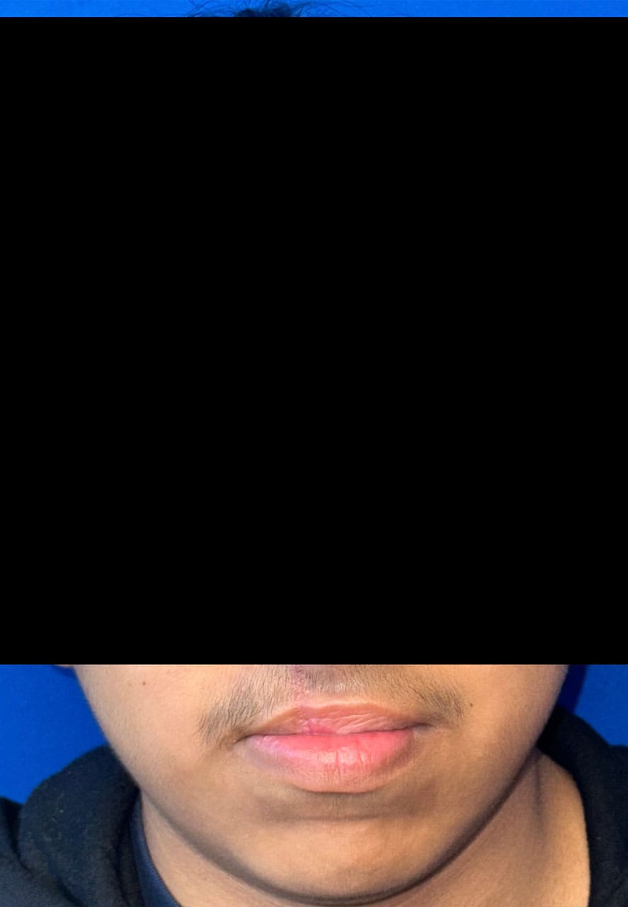 Cleft Lip 1 - MD Art Plastic Surgery